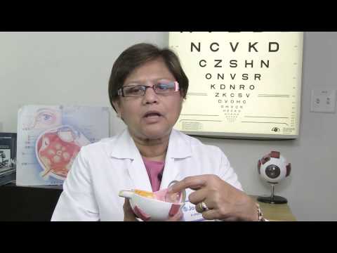 All About Eyes: What is a Cataract