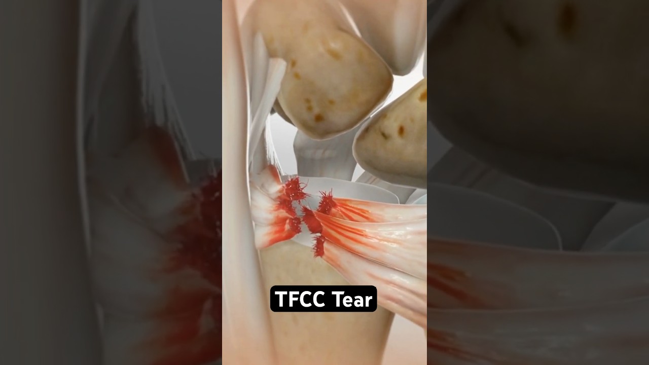 Wrist pain could be a tear (3D Animation)