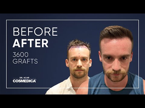 Hair Transplant in Turkey | Results | Dr. Acar | Cosmedica Clinic