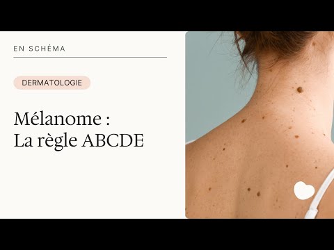 Cancer de la peau : comment le prévenir ? La règle ABCDE