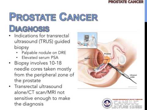 Prostate Cancer - CANUCC Lecture Series