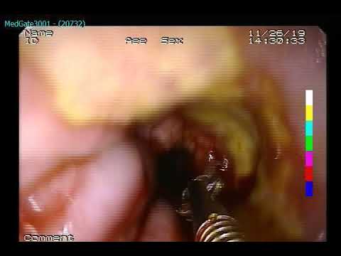 26112019 Gastroscopy and Biopsy for Grade C esophagitis and stricture