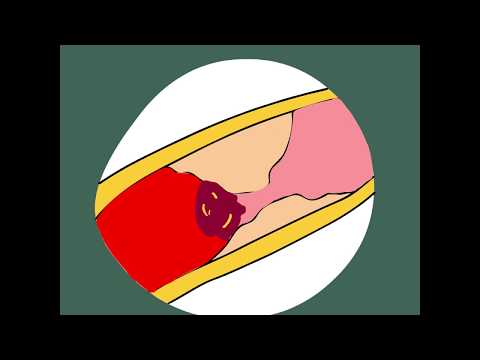 Ischemic Stroke - Animation