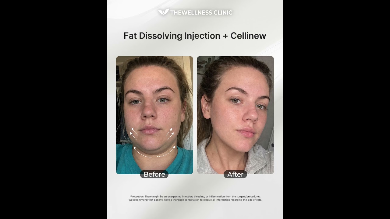 Struggling with stubborn facial fat? See the contouring results of Cellinew and Fat Dissolving duo✨