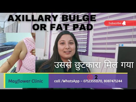 Life-Changing Axillary Breast Surgery Experience: Before and After