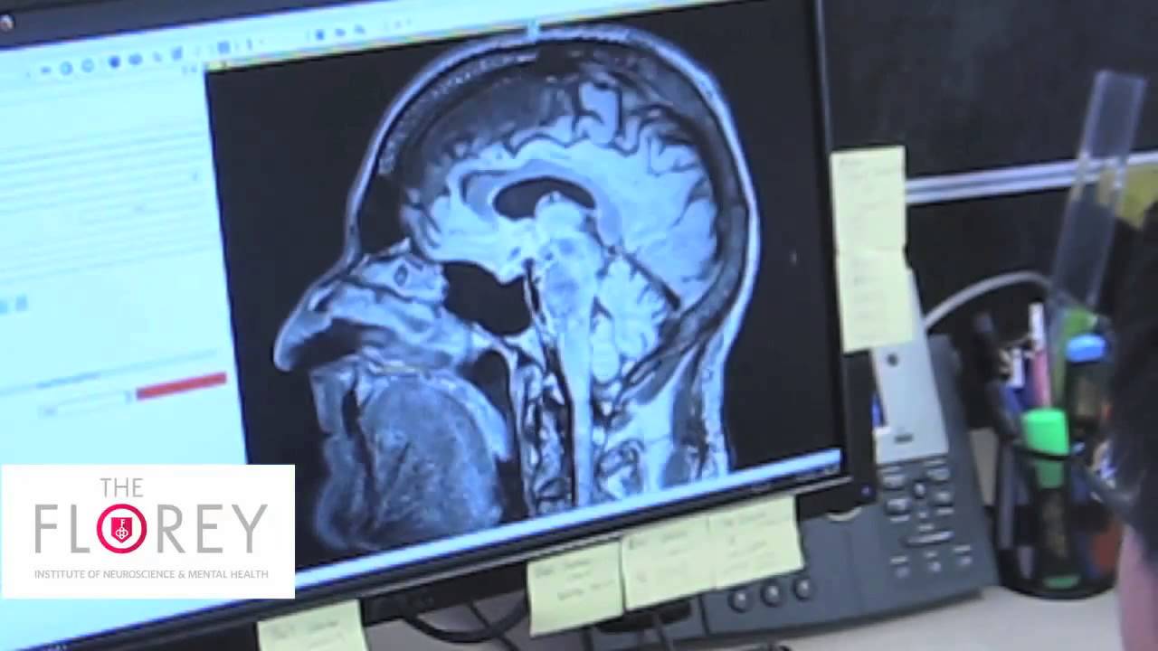 Exploring depression after stroke | Audrey Raffelt