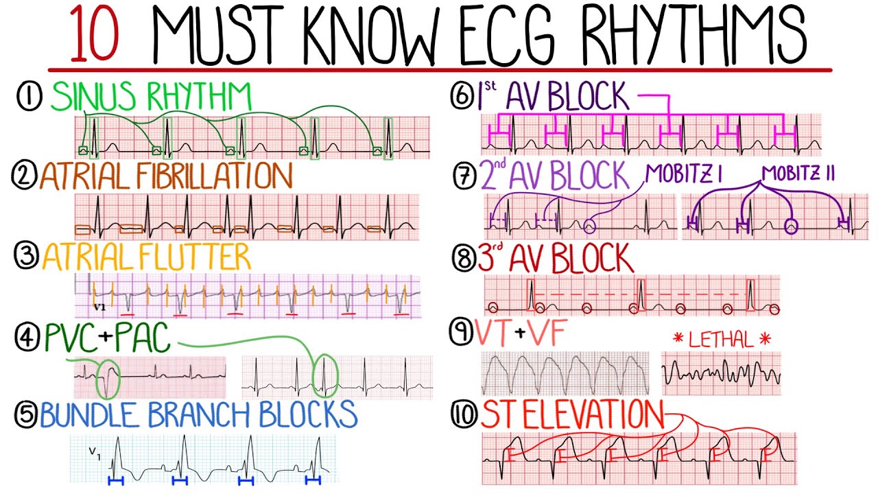 Understanding Common ECG Patterns: A Comprehensive Guide | Galaxy.ai