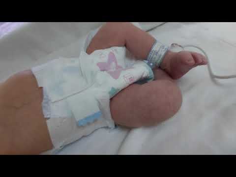 Case 203 what are the causes of mottled skin in neonates? Sepsis, hypothermia, hypoperfusion, normal