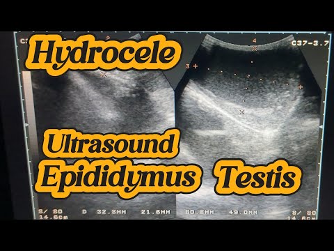 Scrotal Scan | How to Ultrasound Testis | Epididymus Mass Epididymitis | Enlarged Testicle