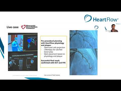 Sponsored webinar | Unlocking the potential of plaque analysis in your CT program