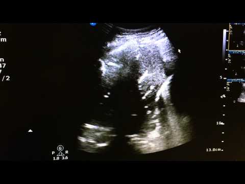Ultrasonic dynamic air bronchograms