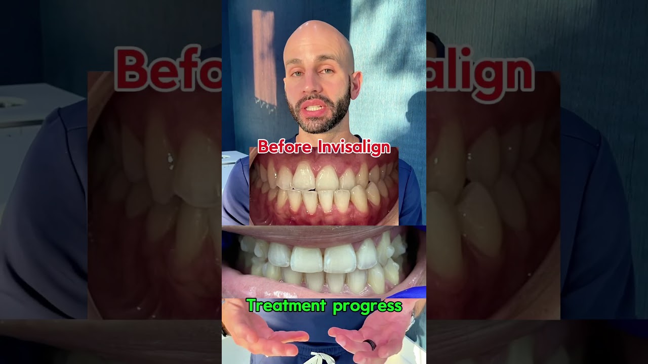 Can Invisalign Fix Underbite?