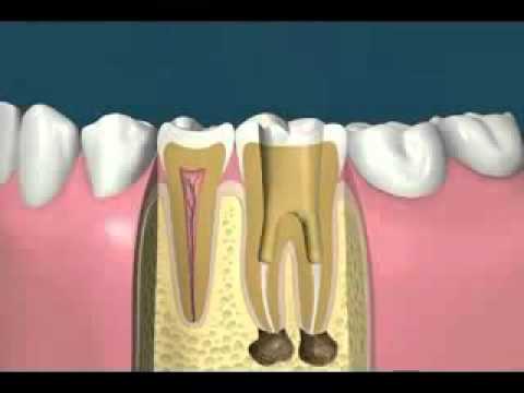 New Image Dentistry shares Root Canal Treatment Procedure in Omaha, NE