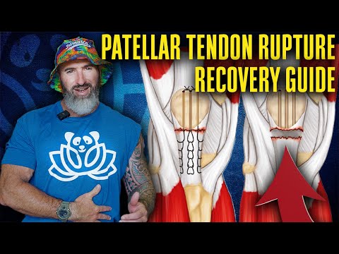 Patellar Tendon Rupture Recovery: 3 Crucial Tips from the World's Leading Expert