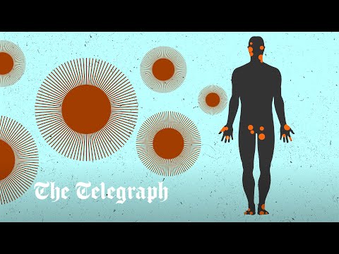 What is monkeypox and how do you know if you’re infected?