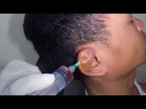 Draining of Massive Ear Hematoma (Cauliflower Ear)