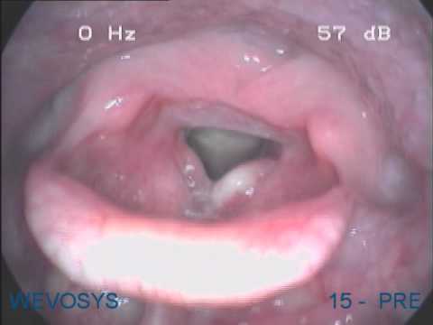 15 - Bilateral Reinke's edema - pre - ROVD