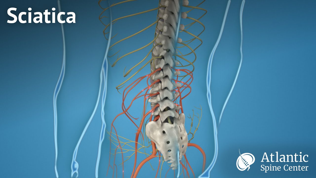 Sciatica