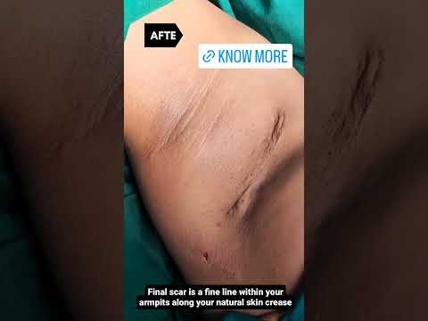 Armpit tissue removal | Accessory breast removal | Dr Karishma Aesthetics Bengaluru India #selfcare