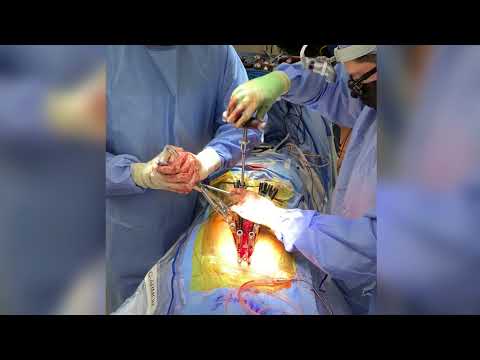 𝐒𝐜𝐨𝐥𝐢𝐨𝐬𝐢𝐬 𝐒𝐮𝐫𝐠𝐞𝐫𝐲 (in the OR)