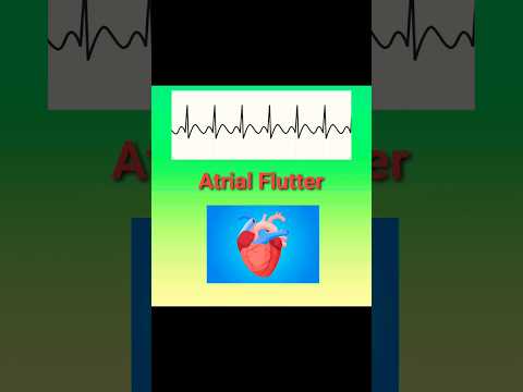 What is Atrial Flutter. Atrial Flutter of Heart. Arrhythmia. Tachycardia #pharmacology