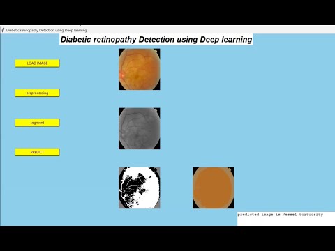 Diabetic Retinopathy Detection with Ensemble Deep Learning | Aislyn