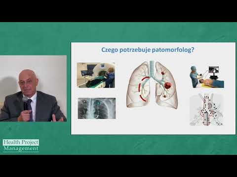 Bronchonawigacja – zastosowanie w diagnostyce raka płuca