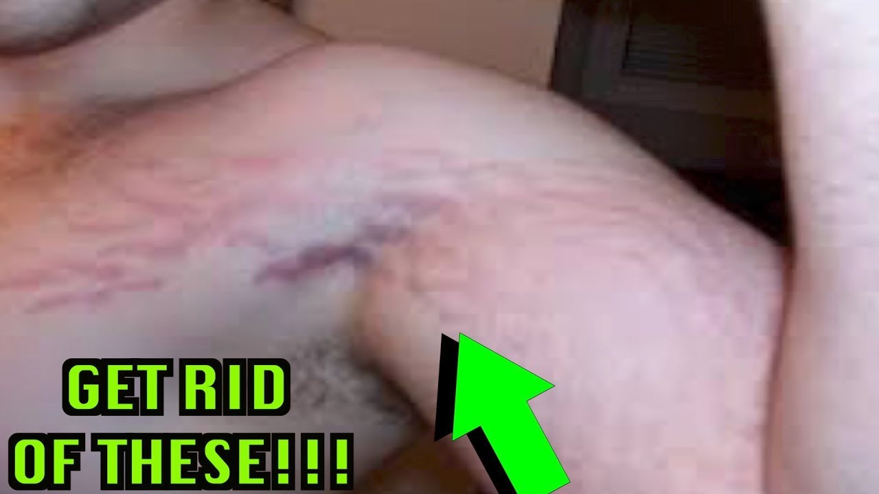 Stretch Marks & Muscle Building | How to Prevent & Get Rid of Them!