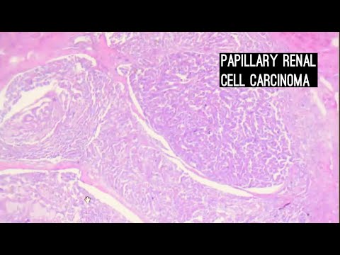 Papillary Renal Cell Carcinoma