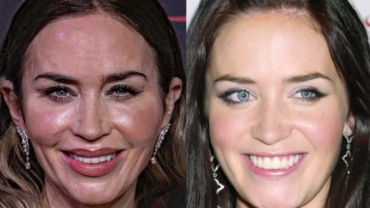Before & After Photos Of Celebrities Who Regret Their Plastic Surgery