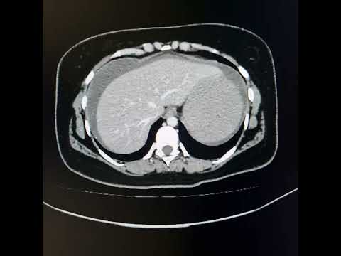 Ruptured ectopic pregnancy.