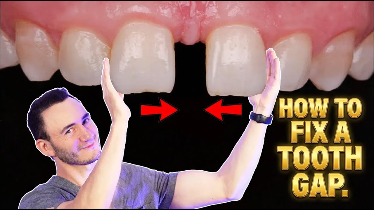 Gap Between Teeth | Best Treatments to Close a Diastema