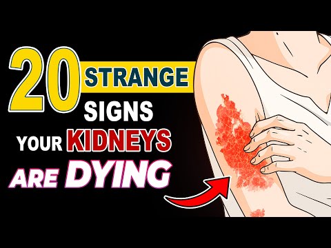 Avoid Dialysis: 20 Weird Signs of Kidney Diseases Most People Will Miss