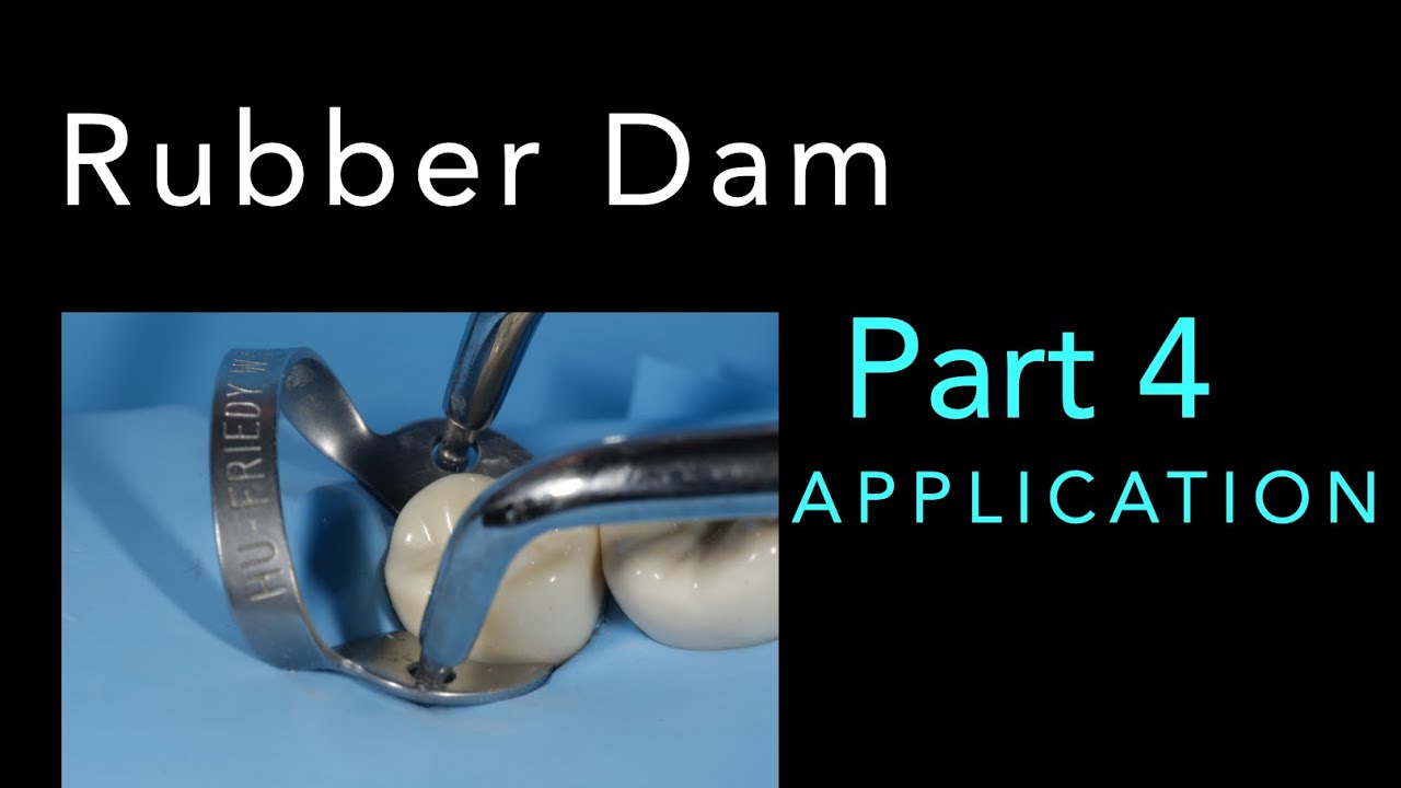 Rubber Dam Isolation, Part 4: Basic Technique for Rubber Dam Application