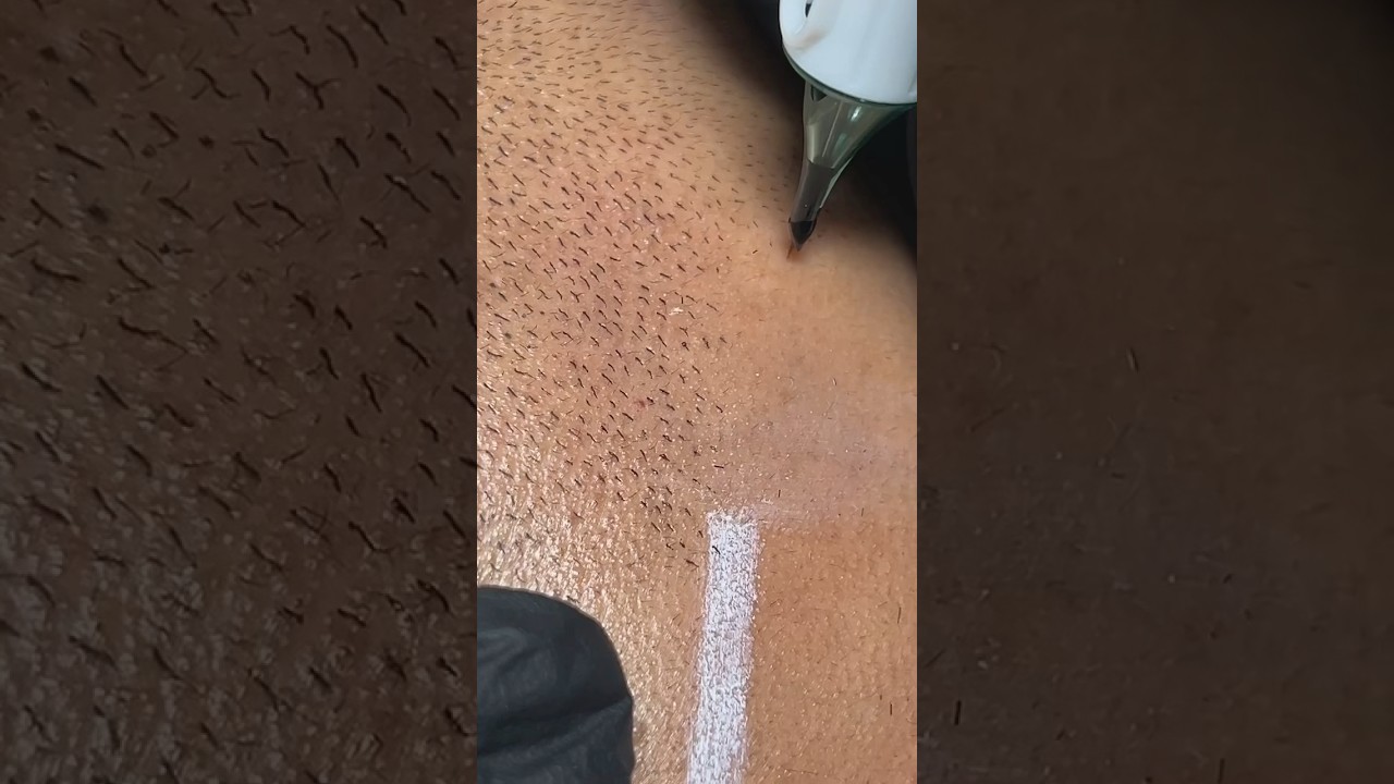 Scalp Micropigmentation should be Undetectable