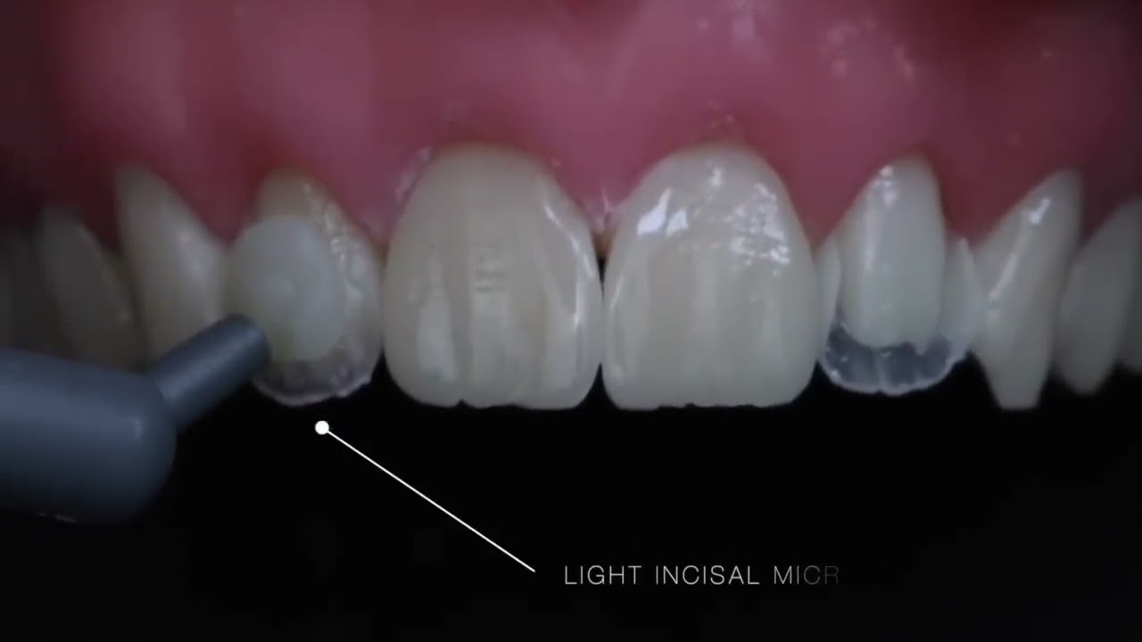Mastering Peg Lateral Restorations: Techniques and Tips from Rhodri ...
