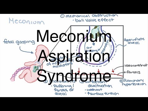 Meconium Aspiration