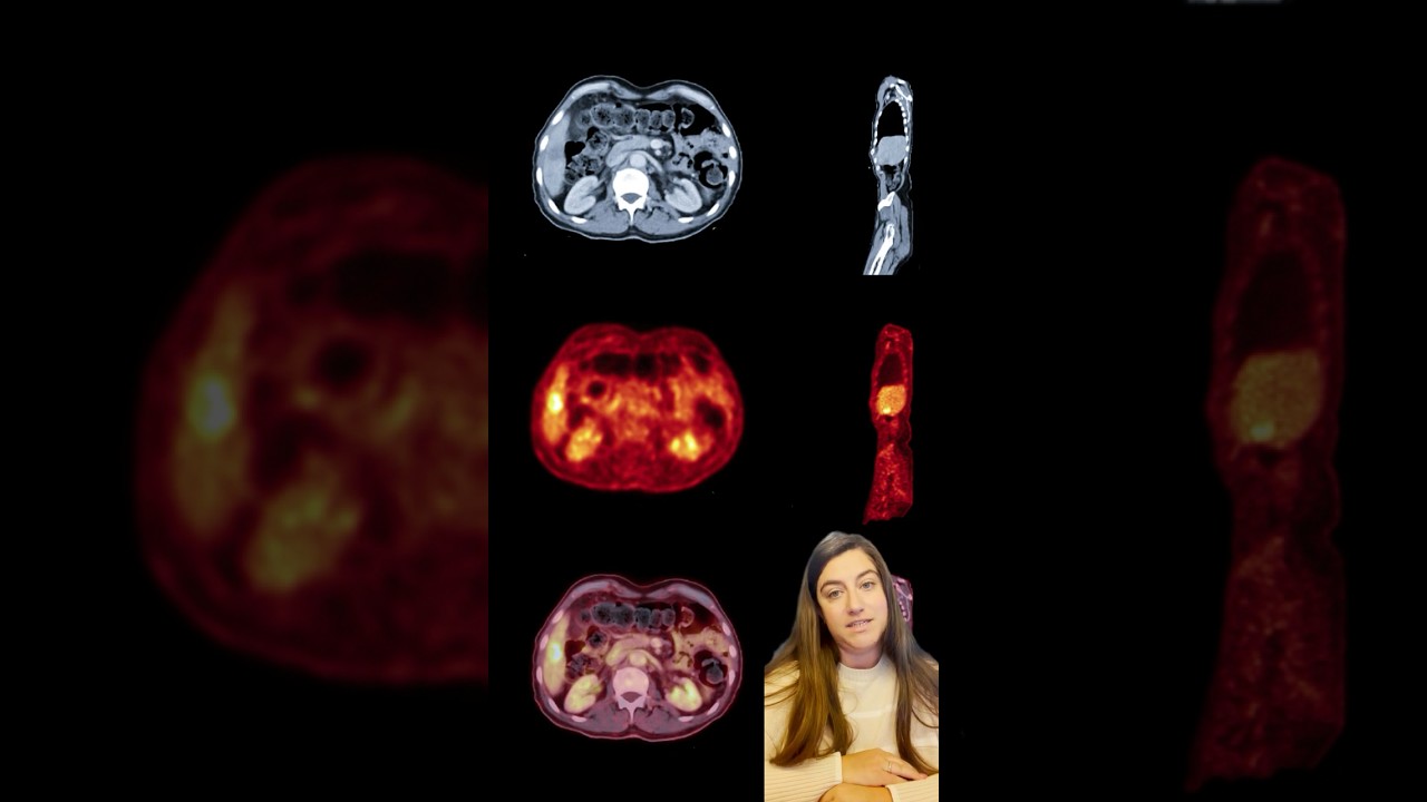 The Basics of PET Scans