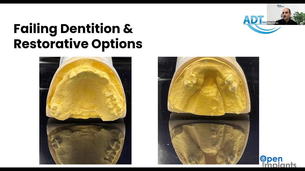 Restoring Complex Full-Arch Cases with a Digital Workflow