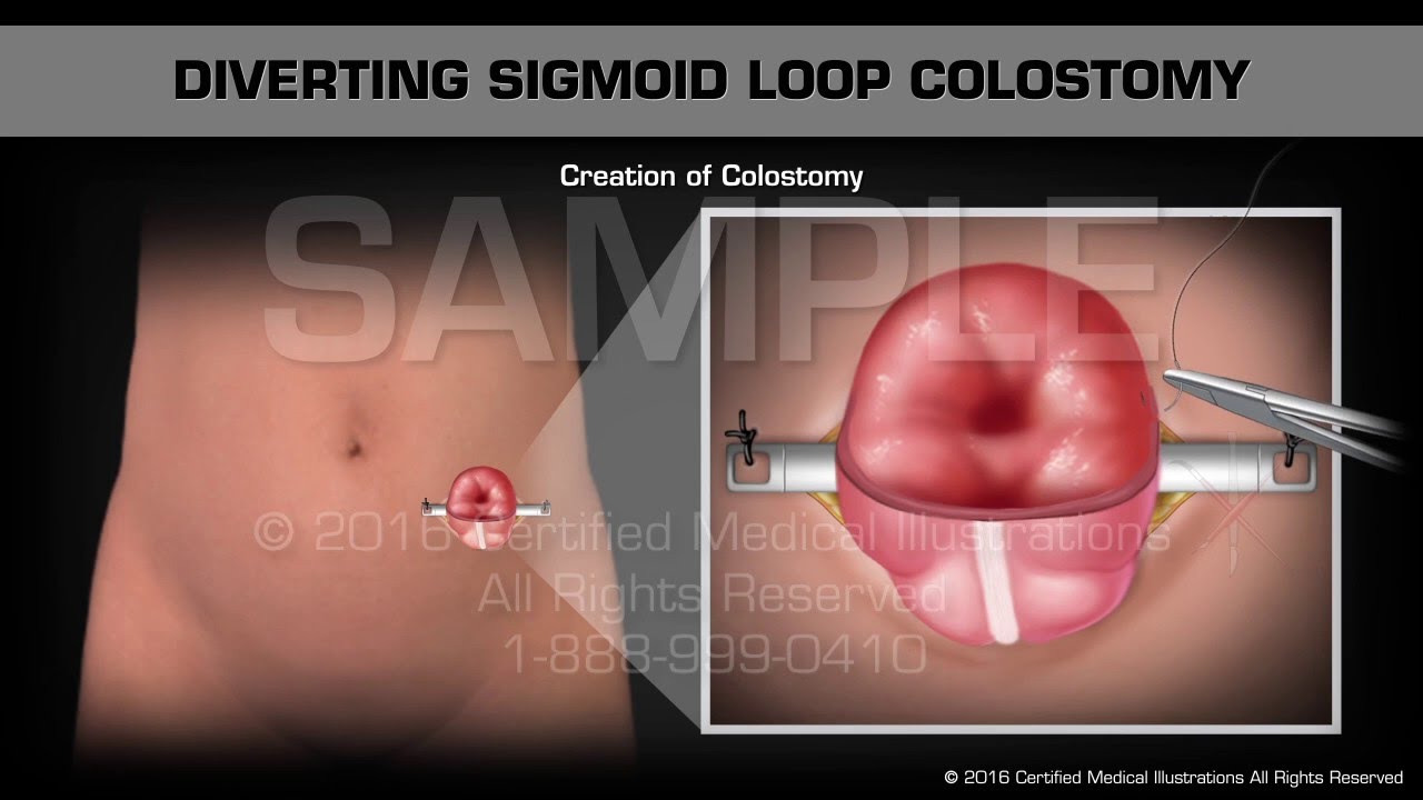 Diverting Sigmoid Loop Colostomy