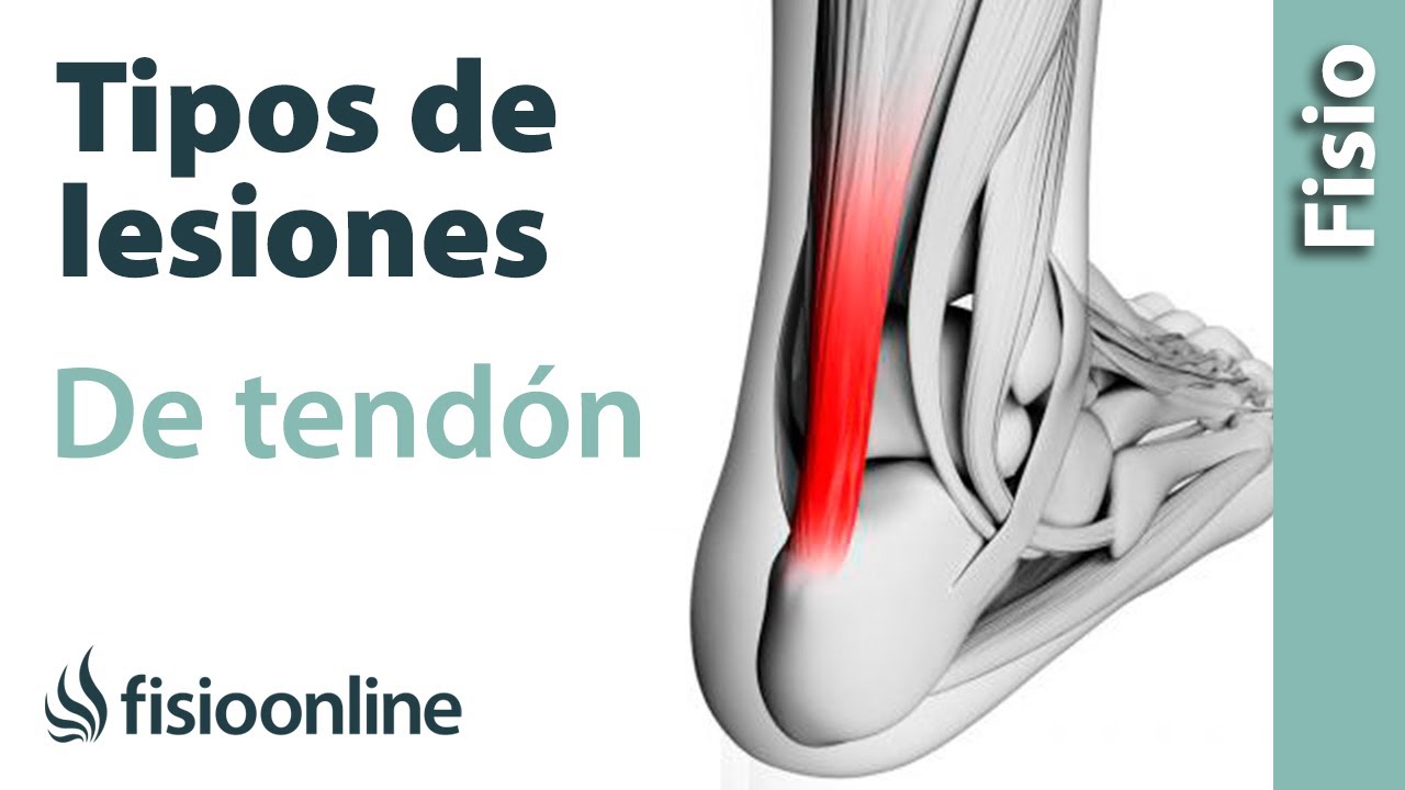 Tipos de LESIONES DE TENDÓN y su tratamiento y recuperación