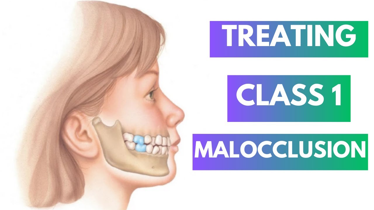 Management of Class 1 Malocclusion -Orthodontics