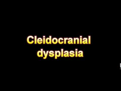 What Is The Definition Of Cleidocranial dysplasia - Medical Dictionary Free Online