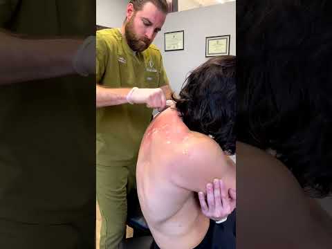 Would You Try Muscle Scraping? Hurts So Good!