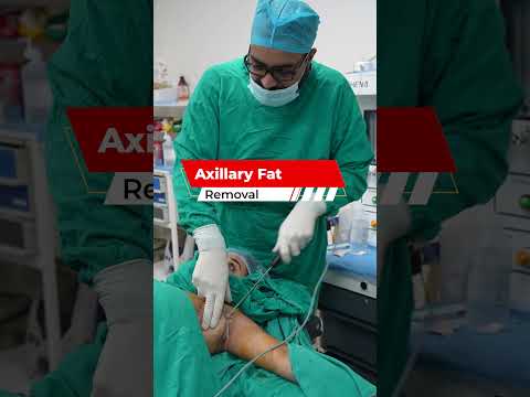 Axillary Fat Removal | Axillary Fat | Axillary Fat cost | Dezire Clinic #shortvideo #shorts
