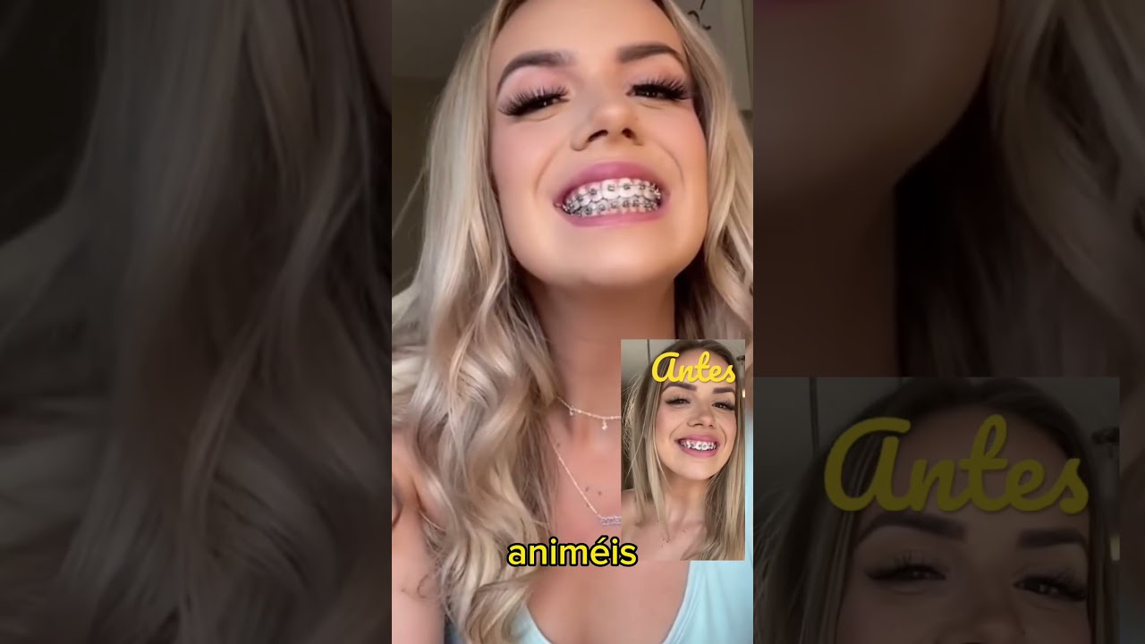Amazing before and after braces!
