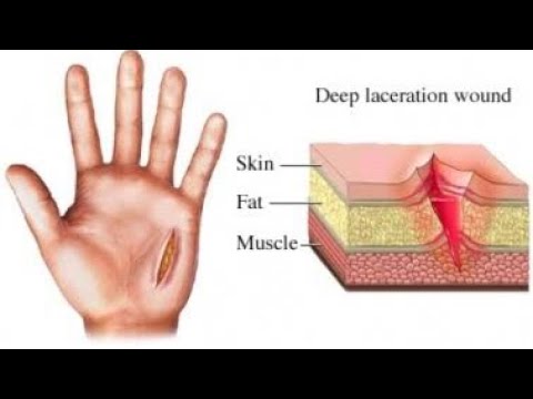 Laceration Wounds ; Definition, Principles of Treatment and Surgery