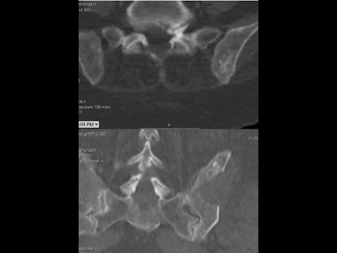 Potential malignancy - don't ignore it !! Enchondroma or chondrosarcoma ?