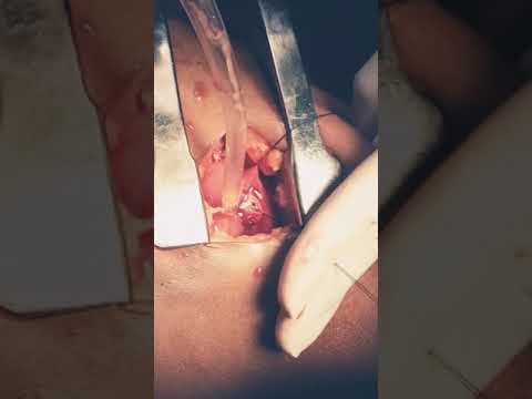 Drainage of Pericardial effusion and tamponade
