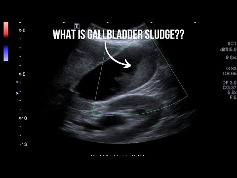 Ultrasound Abdomen What is gallbladder sludge?